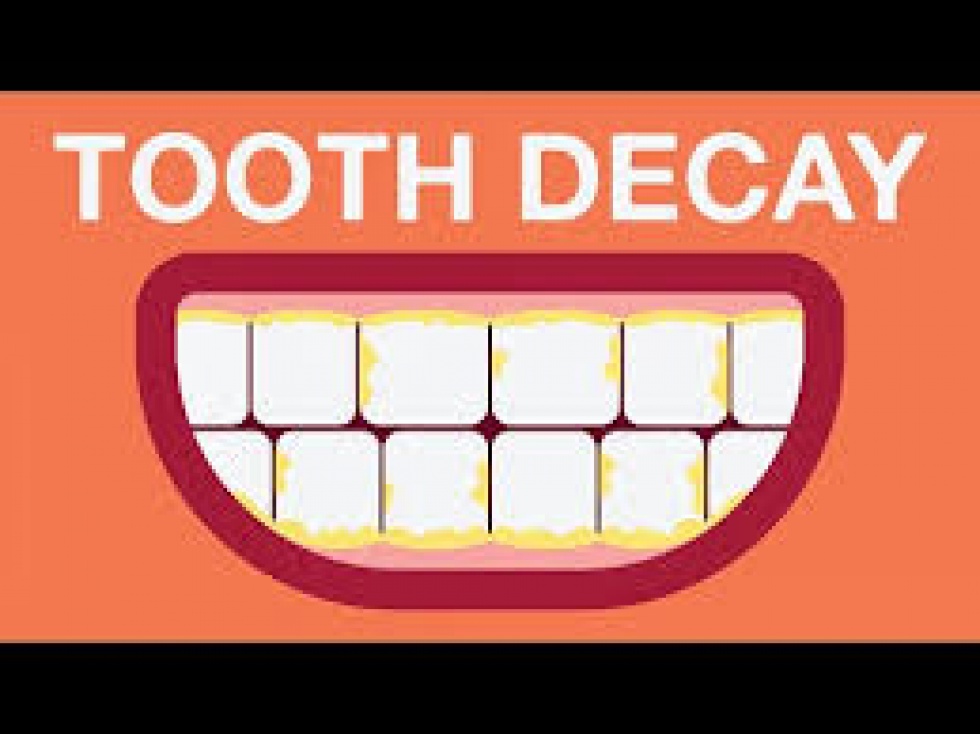Year 4 Science: Tooth Decay Update